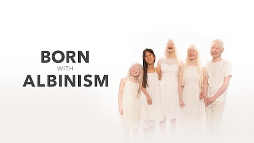 Watch Born With Albinism | discovery+