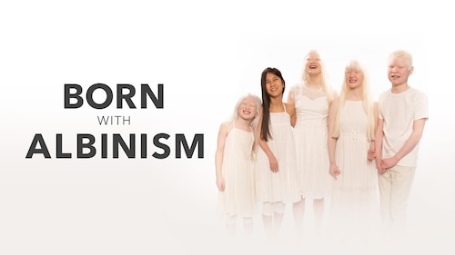 Watch Born With Albinism | discovery+